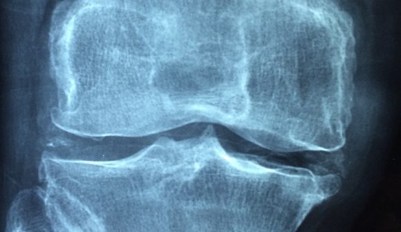 Function of the kneecap - Malvern Physio Clinic